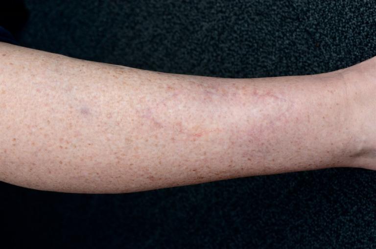 Post Op Wound Healing & Care - Dr Stretch Post Op Wound Healing & Care - Dr Stretch